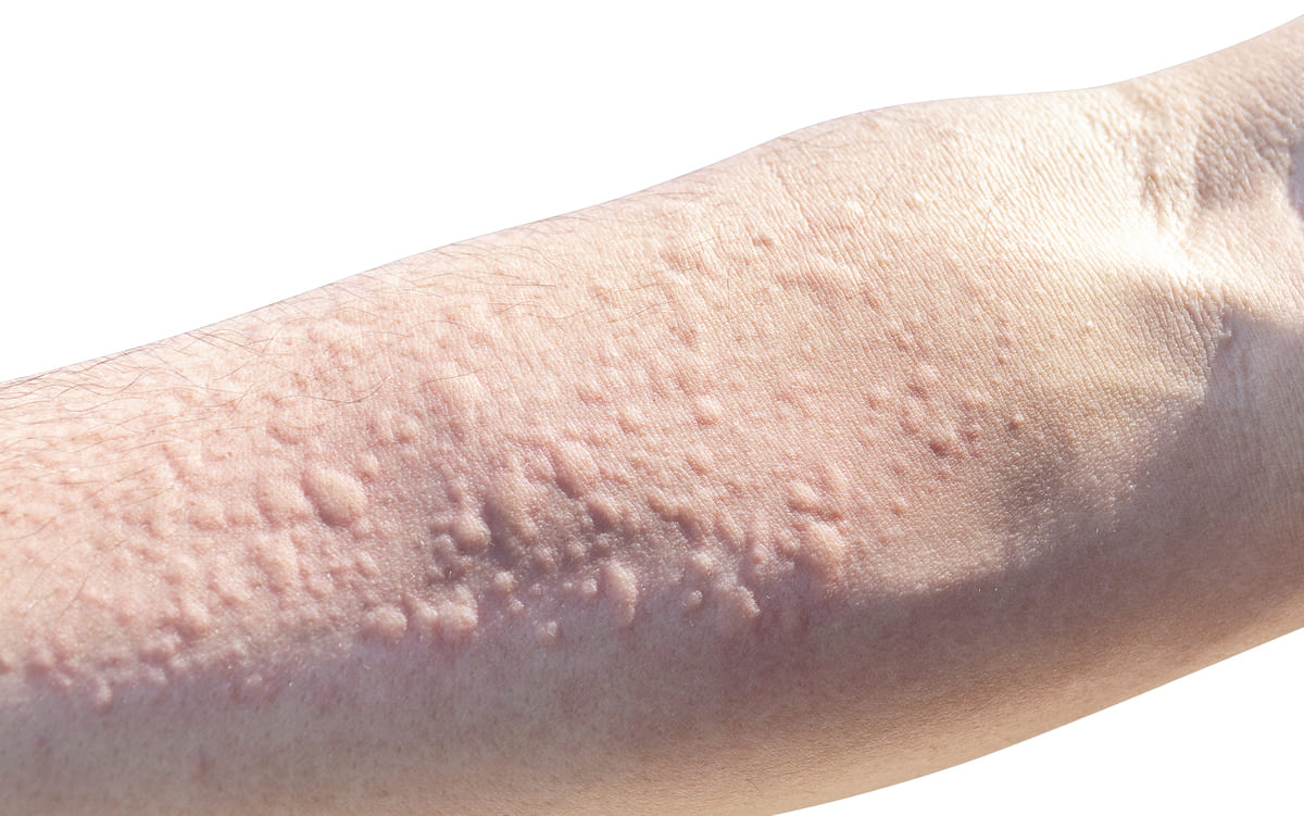 Ayurvedic Treatment for Urticaria: A Bangalore Doctor's Guide to ...